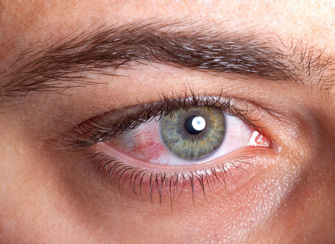 Fique atento às alergias oculares - DermaVisus