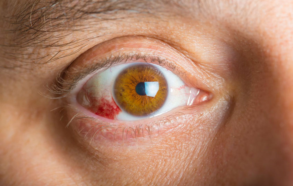 Conjuntivites: tudo o que você precisa saber ‹ DermaVisus